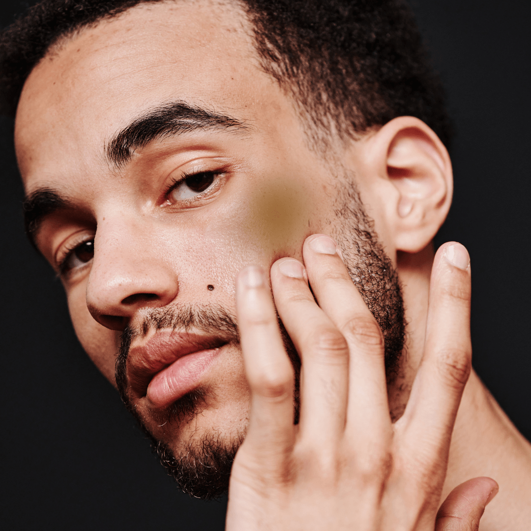 Melasma vs. Hyperpigmentation: Understanding the Key Differences – TMGskin.com